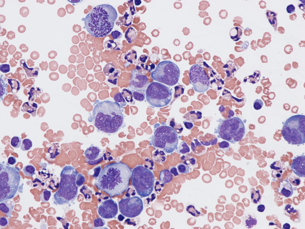 Outcomes of Relapsed or Refractory Diffuse Large B-Cell Lymphoma ...