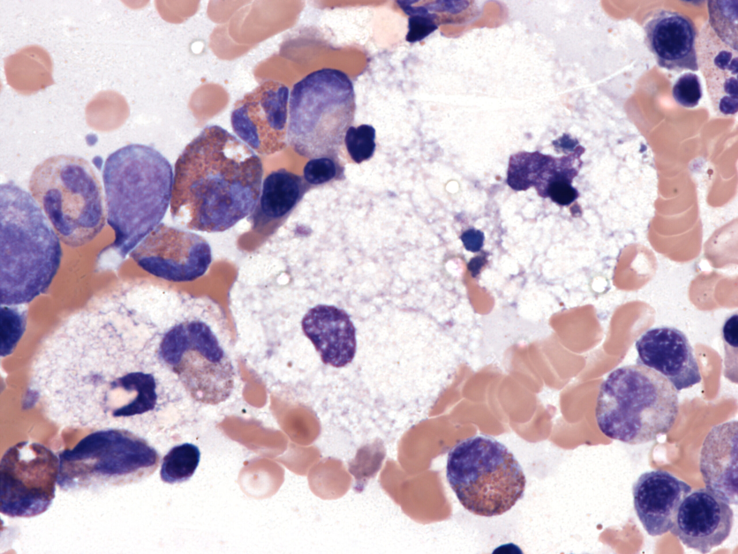 Open-Label Extension Study Testing Arimoclomol in Patients With NPC ...